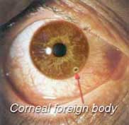 Corneal Foreign Body