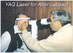 What is Posterior Capsular Opacification (PCO) or After Cataract ...