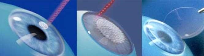 What is iLASIK? What is IntraLaseTM technology? | Shroff Eye Centre