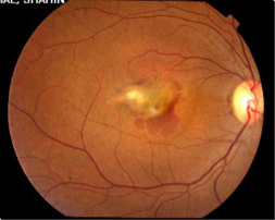 Wet Age-Related Macular Degeneration | Shroff Eye Centre