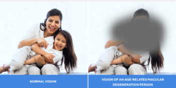 Wet Age Macular Degeneration: Symptoms, Causes & Treatment