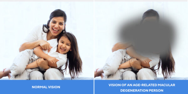 Wet Age Macular Degeneration: Symptoms, Causes & Treatment
